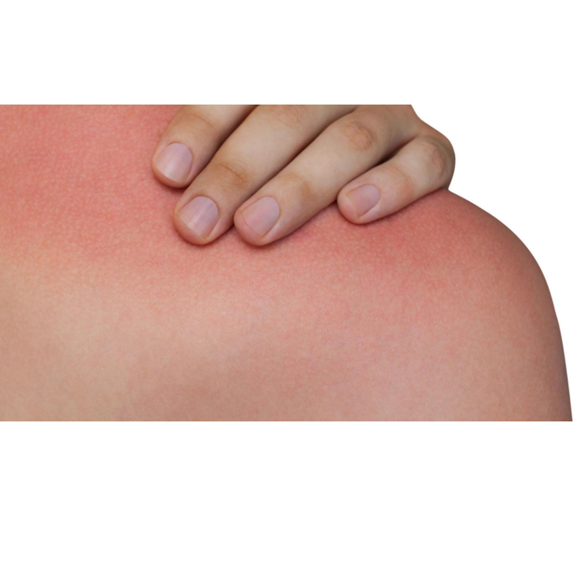 Sunburn Explained: Symptoms & How to Treat It | medino